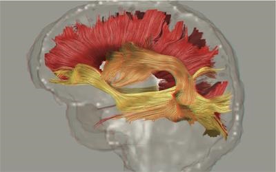 Frayed Wiring Found Throughout the Brain in Schizophrenia Patients ...