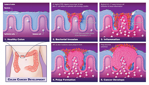 Two Bacterial Species Collaborate to Promote Colon Cancer | Biocompare ...